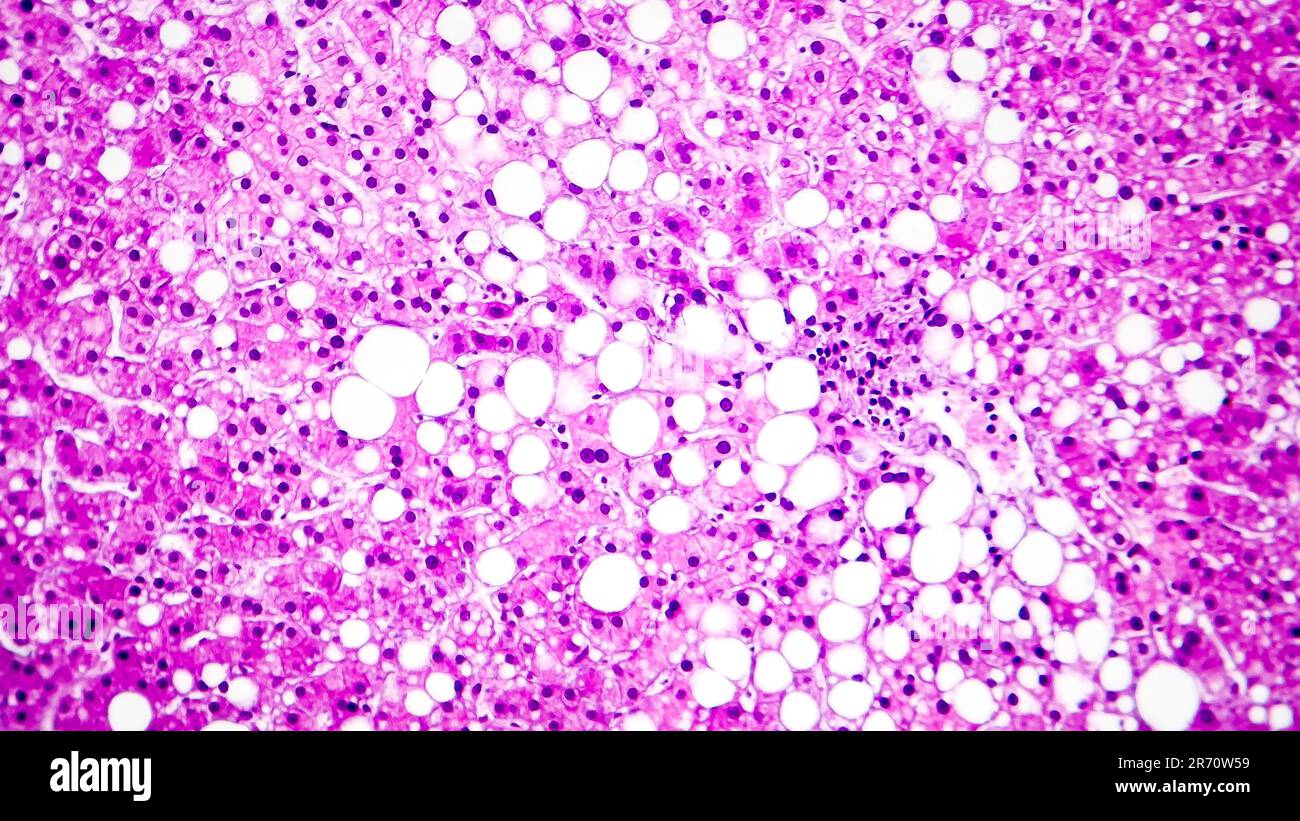 Histopathology of liver steatosis, or fatty liver. Light micrograph ...