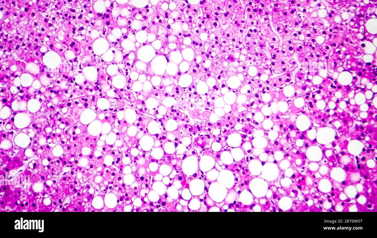 Histopathology of liver steatosis, or fatty liver. Light micrograph ...