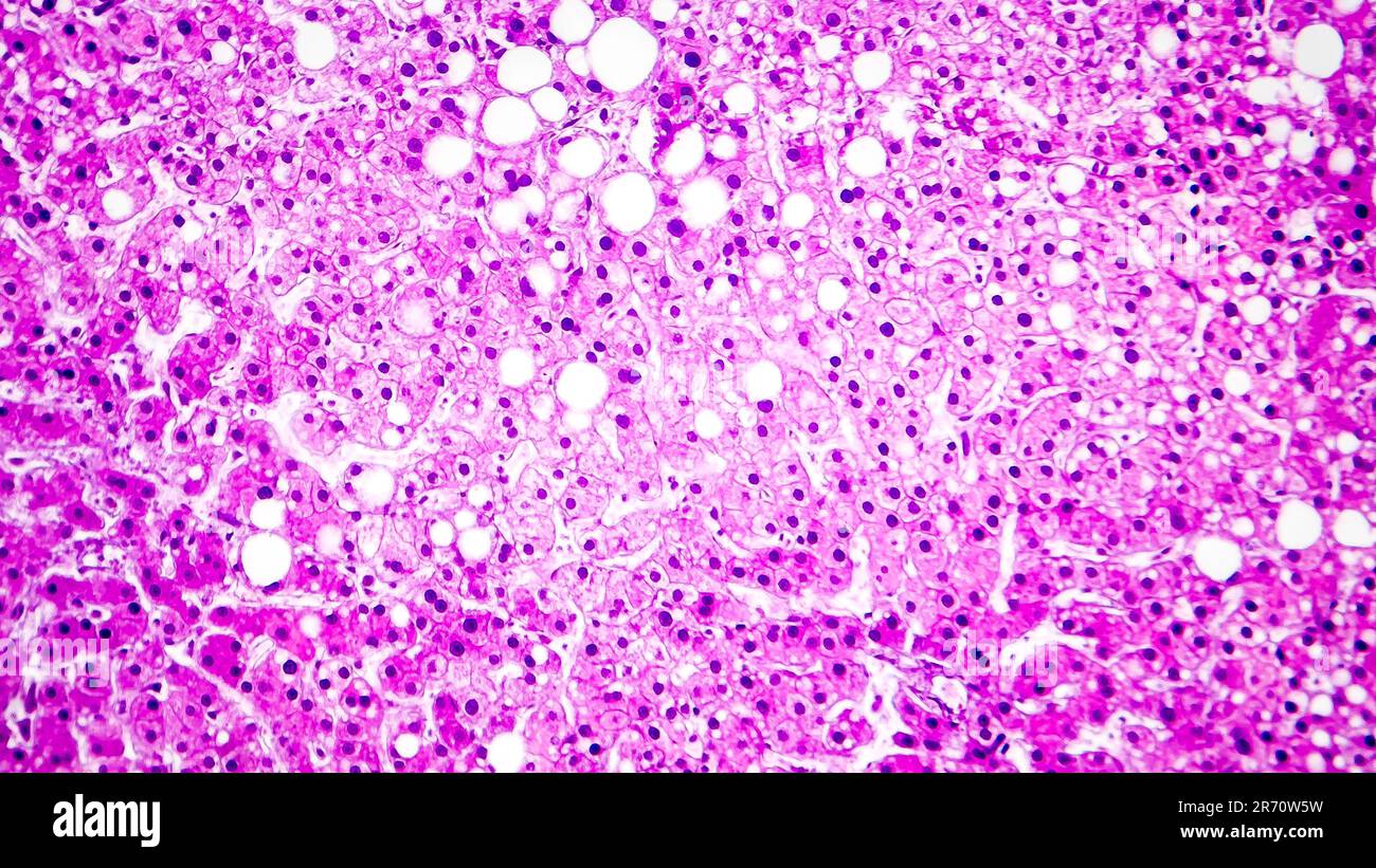 Histopathology of liver steatosis, or fatty liver. Light micrograph ...
