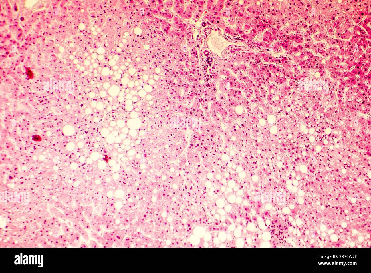 Fatty liver, liver steatosis. Photomicrograph showing large vacuoles of ...