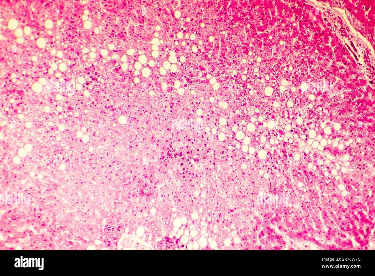 Fatty liver, liver steatosis. Photomicrograph showing large vacuoles of ... Fatty liver, liver steatosis. Photomicrograph showing large vacuoles of ...