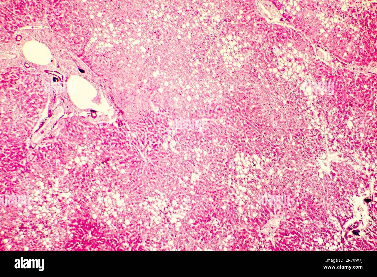 Fatty liver, liver steatosis. Photomicrograph showing large vacuoles of ...