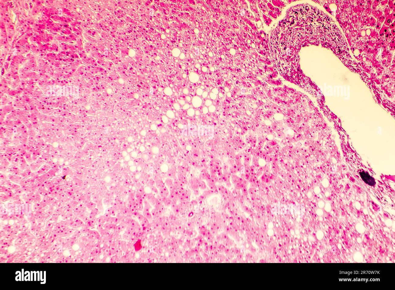 Fatty liver, liver steatosis. Photomicrograph showing large vacuoles of ... Fatty liver, liver steatosis. Photomicrograph showing large vacuoles of ...
