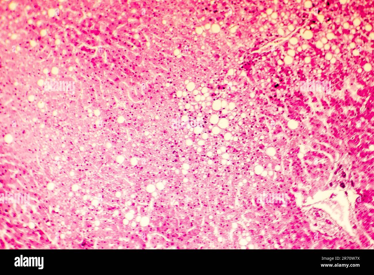 Fatty liver, liver steatosis. Photomicrograph showing large vacuoles of ...