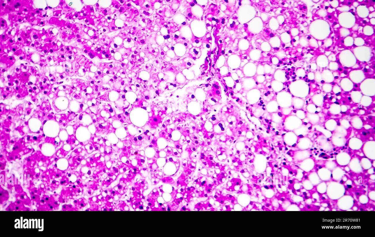 Histopathology of liver steatosis, or fatty liver. Light micrograph ...