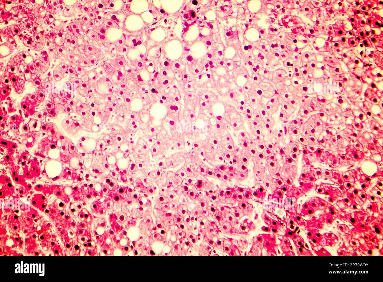 Fatty liver, liver steatosis. Photomicrograph showing large vacuoles of ...