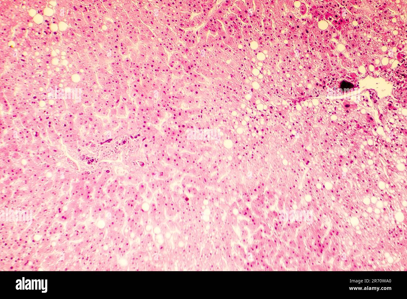 Fatty liver, liver steatosis. Photomicrograph showing large vacuoles of ...