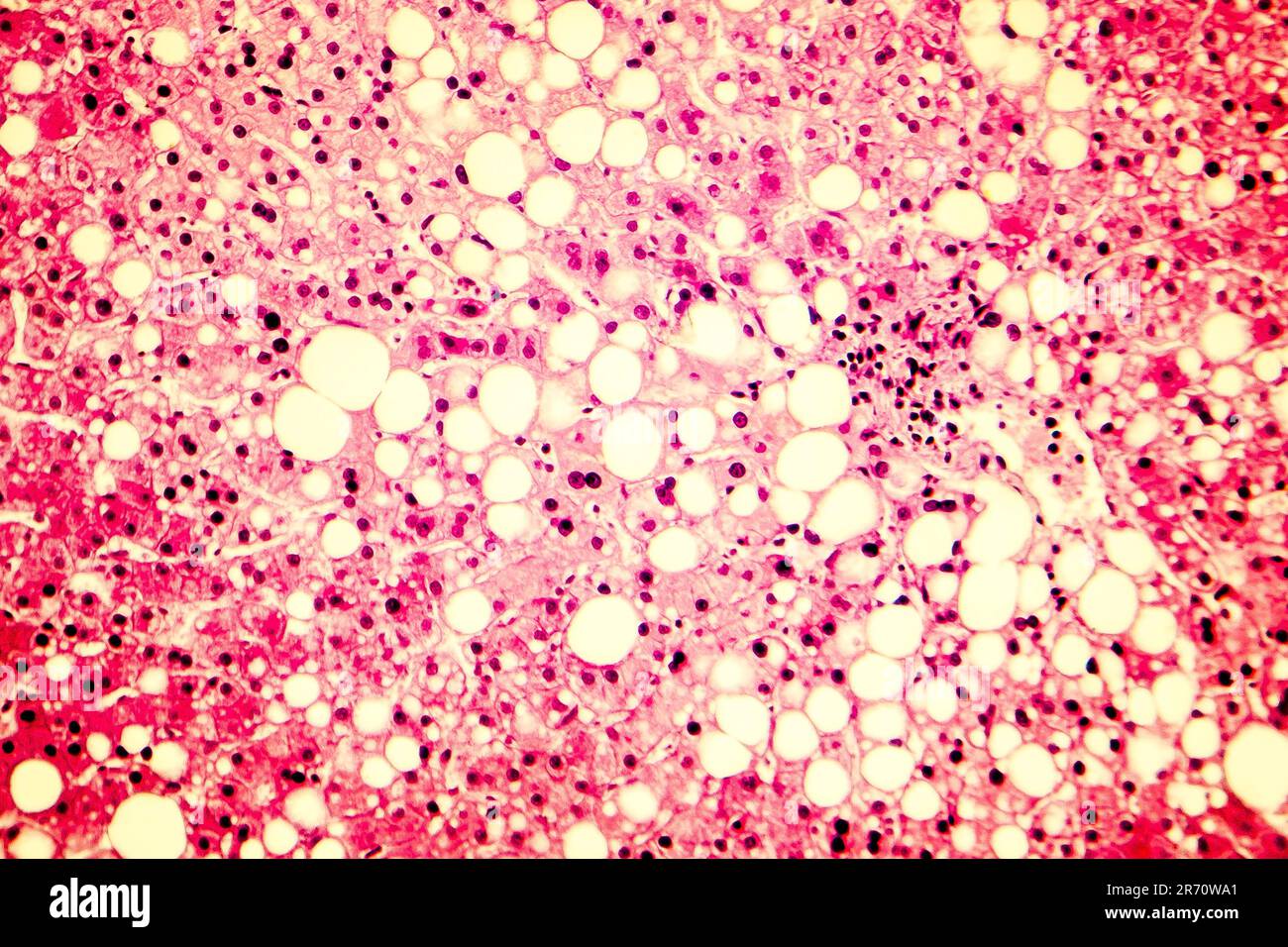 Fatty liver, liver steatosis. Photomicrograph showing large vacuoles of ...