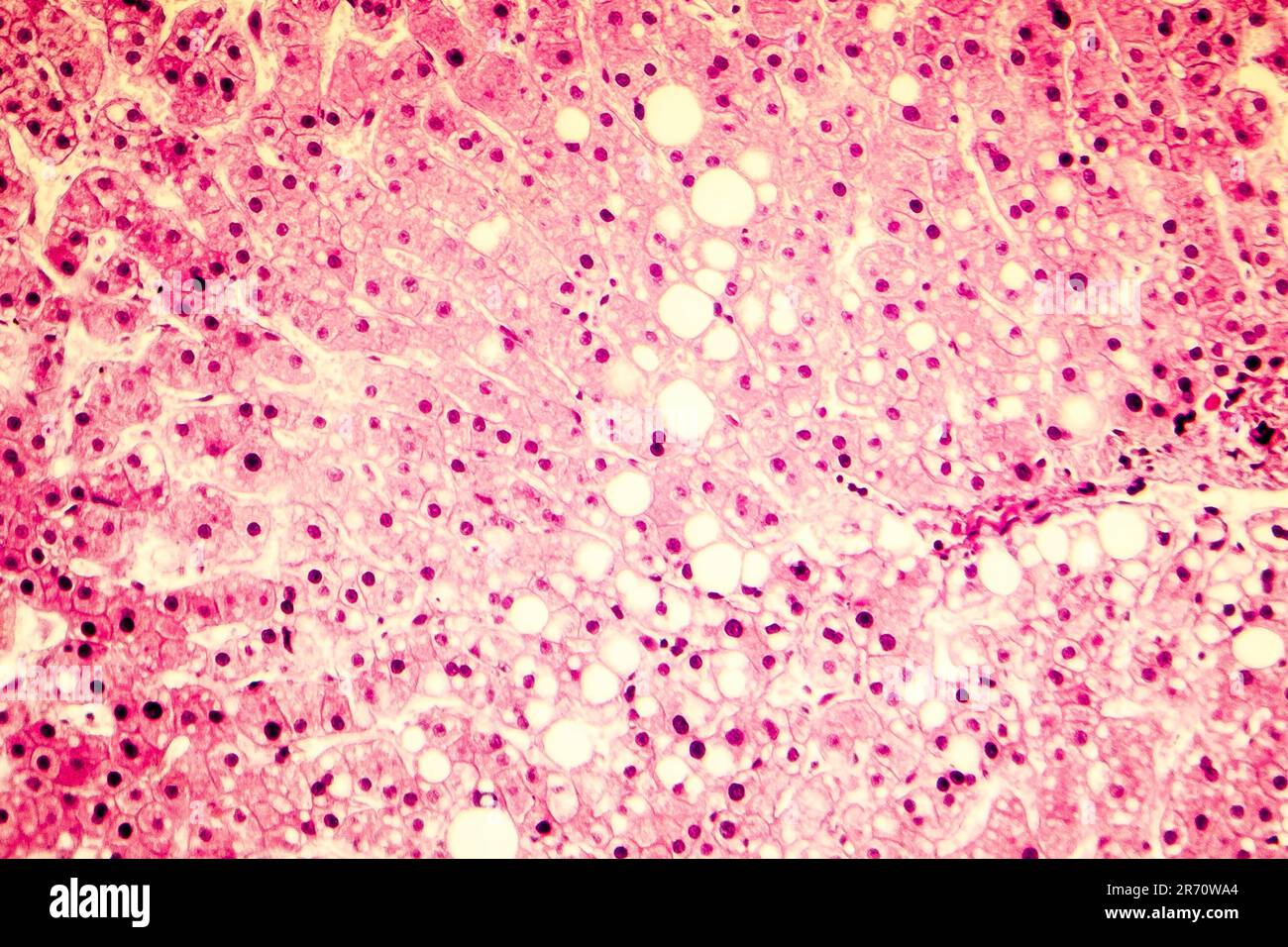 Fatty liver, liver steatosis. Photomicrograph showing large vacuoles of ...