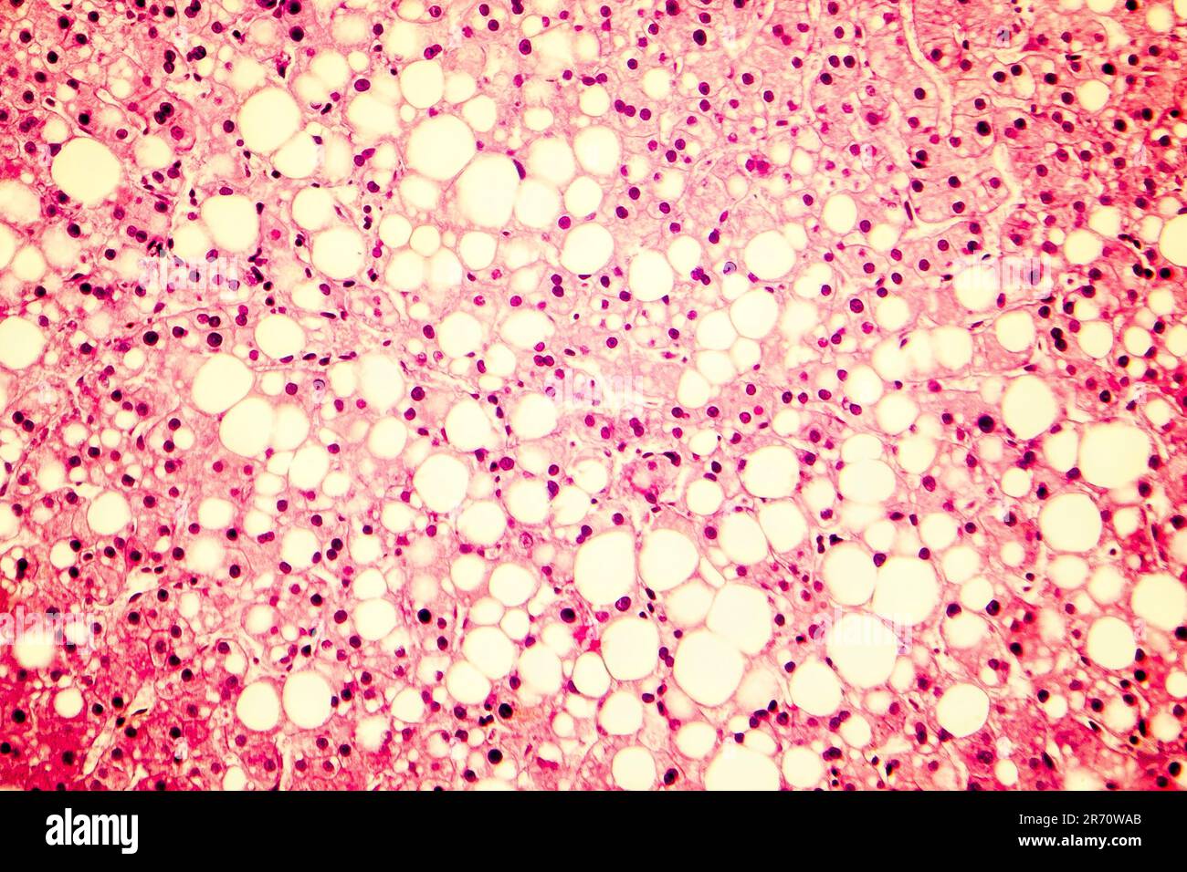 Fatty liver, liver steatosis. Photomicrograph showing large vacuoles of ... Fatty liver, liver steatosis. Photomicrograph showing large vacuoles of ...