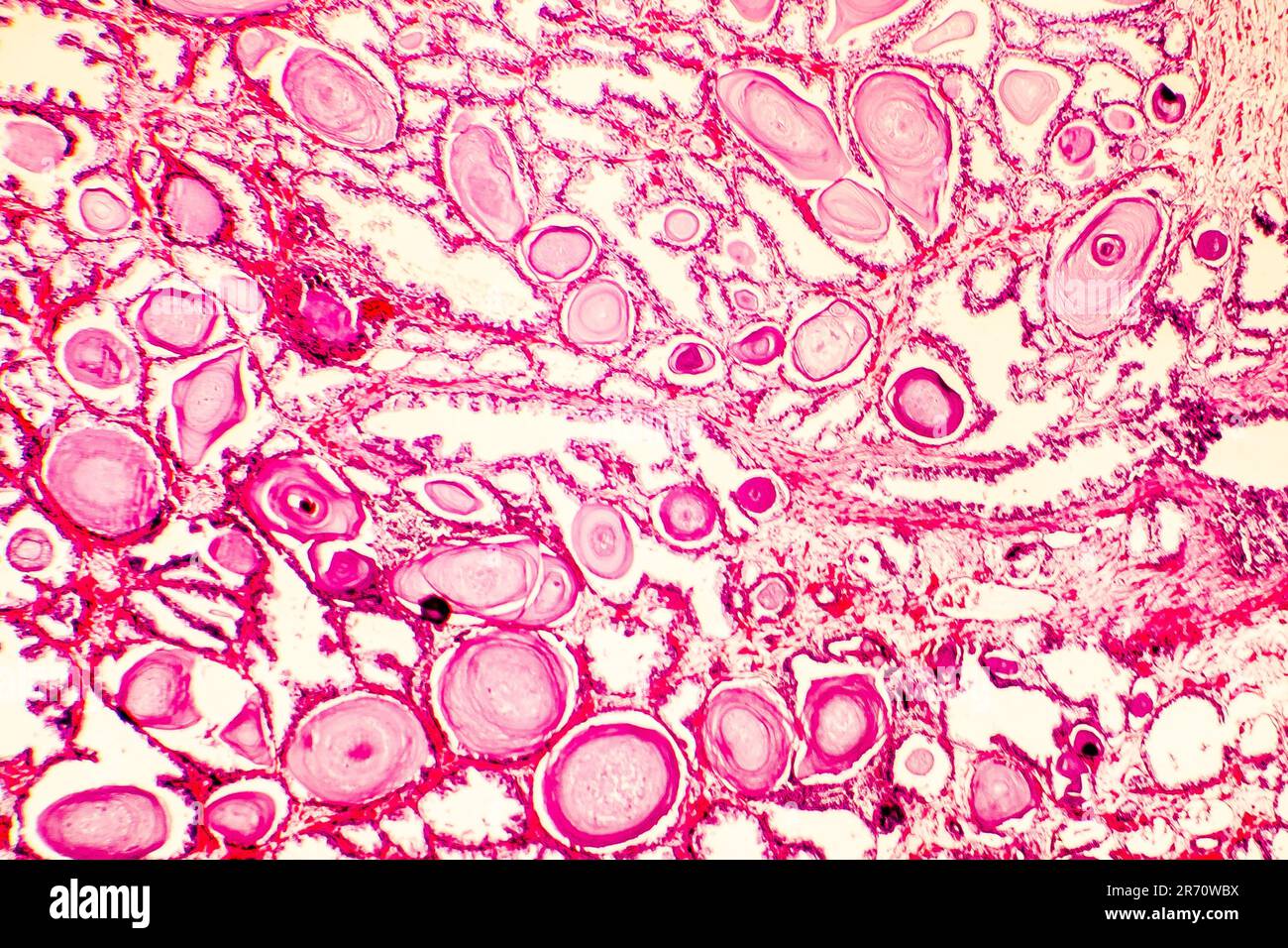 Prostate hyperplasia. Photomicrograph showing dilated glands, enfolding ...