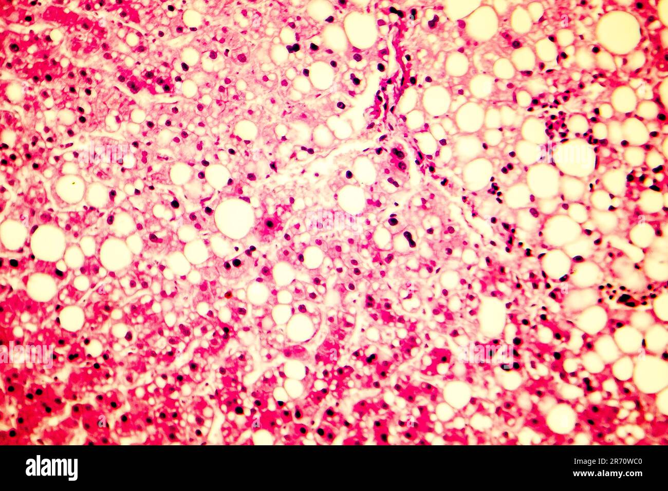 Fatty liver, liver steatosis. Photomicrograph showing large vacuoles of ...