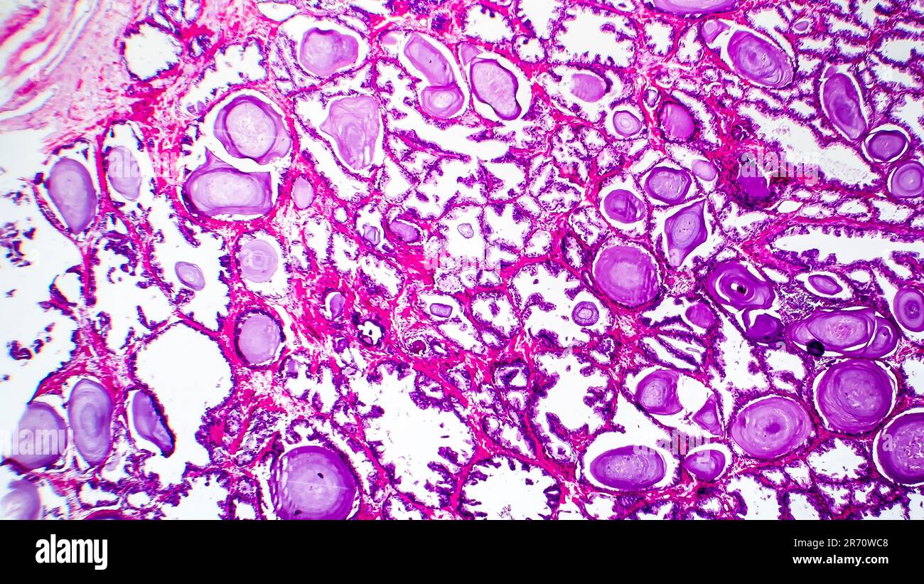 Histopathology of prostate gland hyperplasia, light micrograph, photo ...