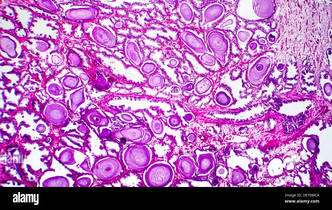 Light micrograph benign prostate hi-res stock photography and images ...