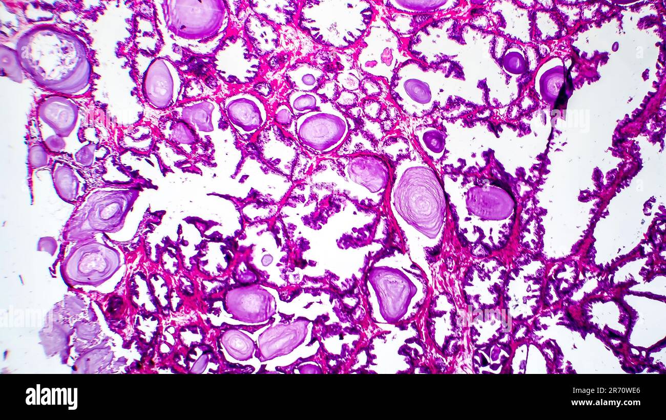 Histopathology of prostate gland hyperplasia, light micrograph, photo ...