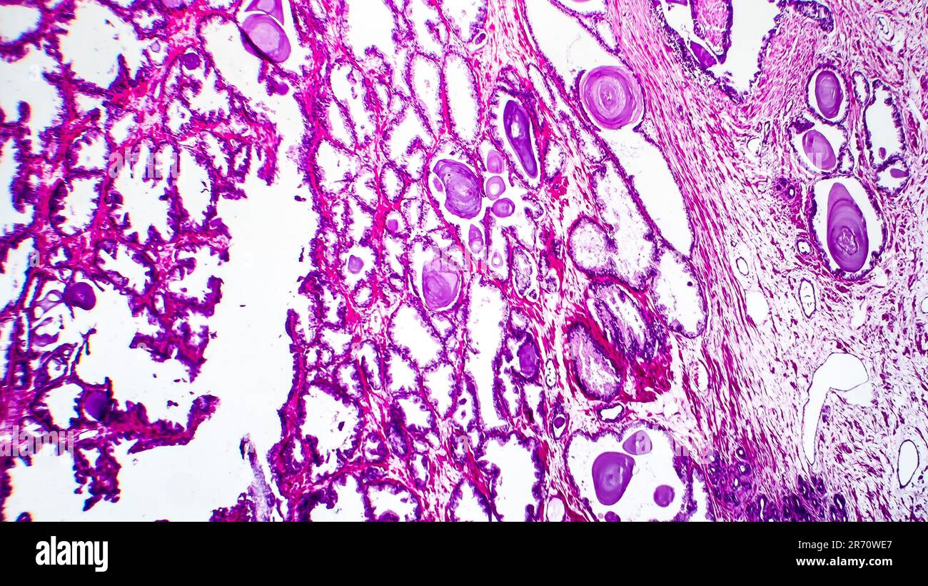 Histopathology of prostate gland hyperplasia, light micrograph, photo ...