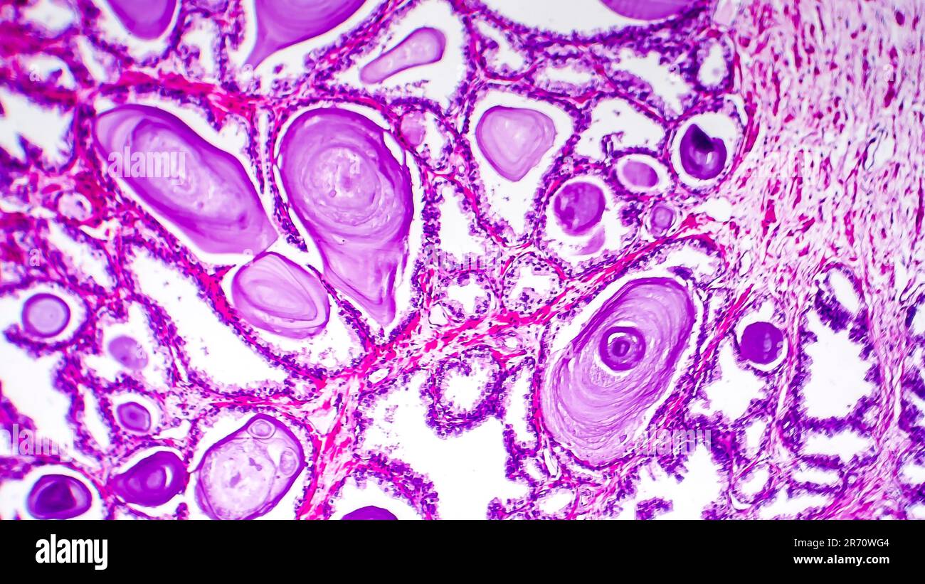 Histopathology of prostate gland hyperplasia, light micrograph, photo ...