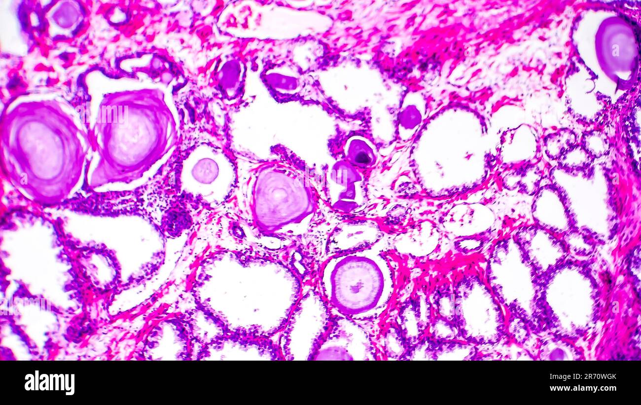 Histopathology of prostate gland hyperplasia, light micrograph, photo ...