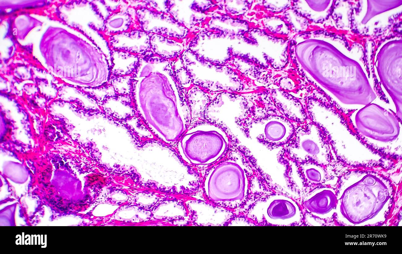 Histopathology of prostate gland hyperplasia, light micrograph, photo ...