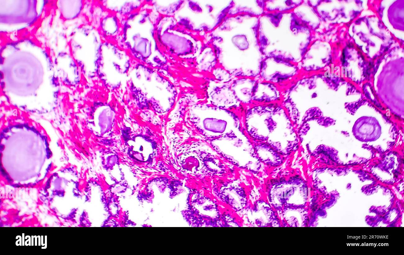 Histopathology of prostate gland hyperplasia, light micrograph, photo ...