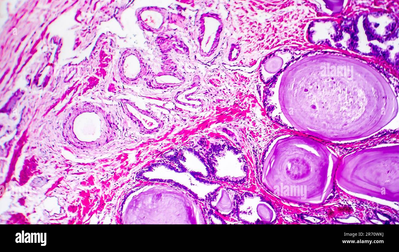 Histopathology of prostate gland hyperplasia, light micrograph, photo ...