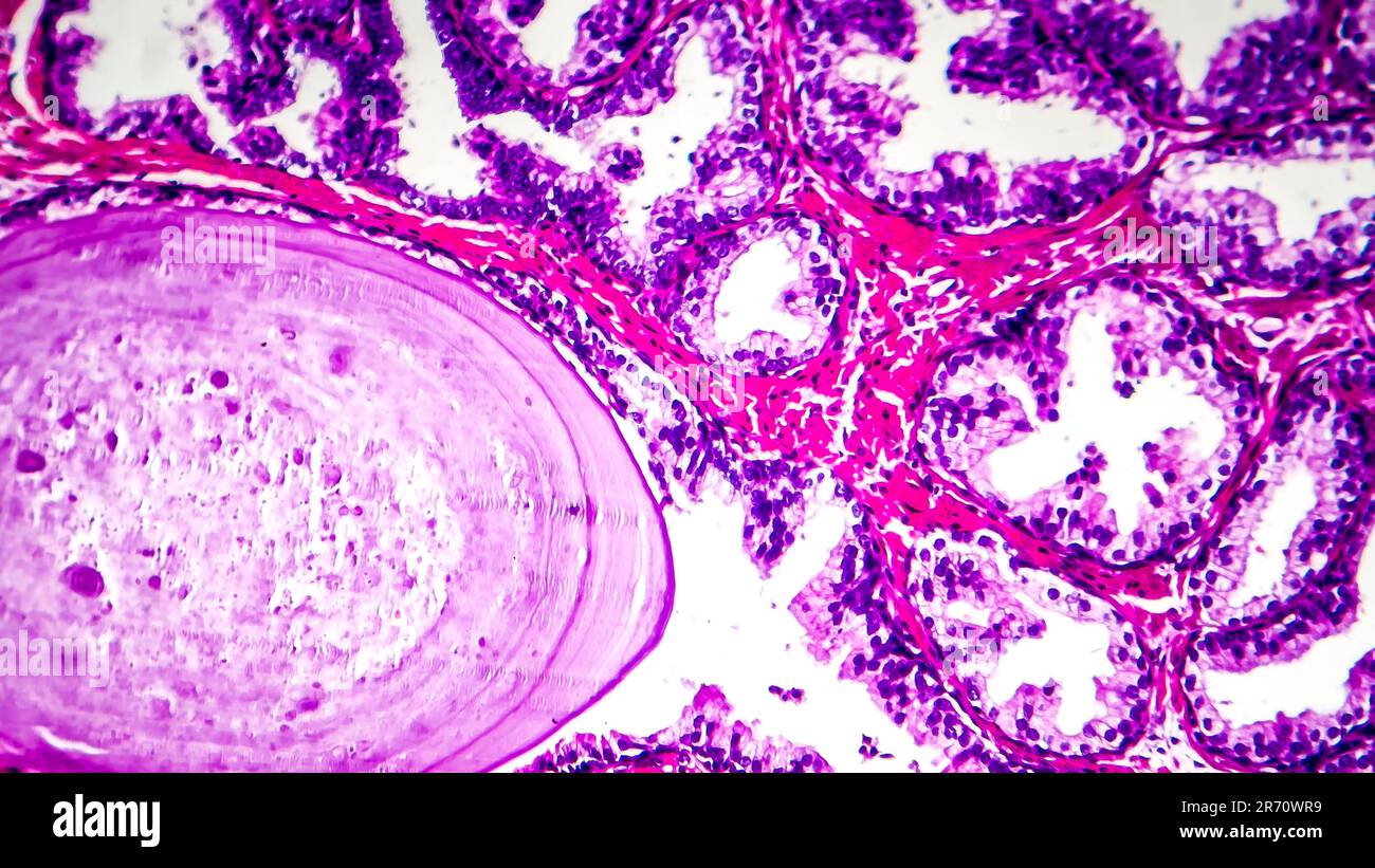 Light micrograph benign prostate hi-res stock photography and images ...