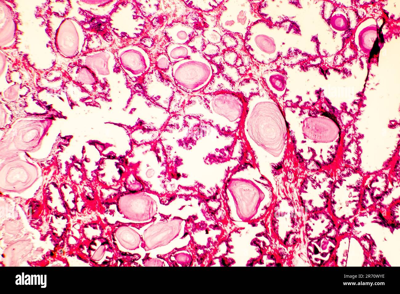 Prostate hyperplasia. Photomicrograph showing dilated glands, enfolding ...