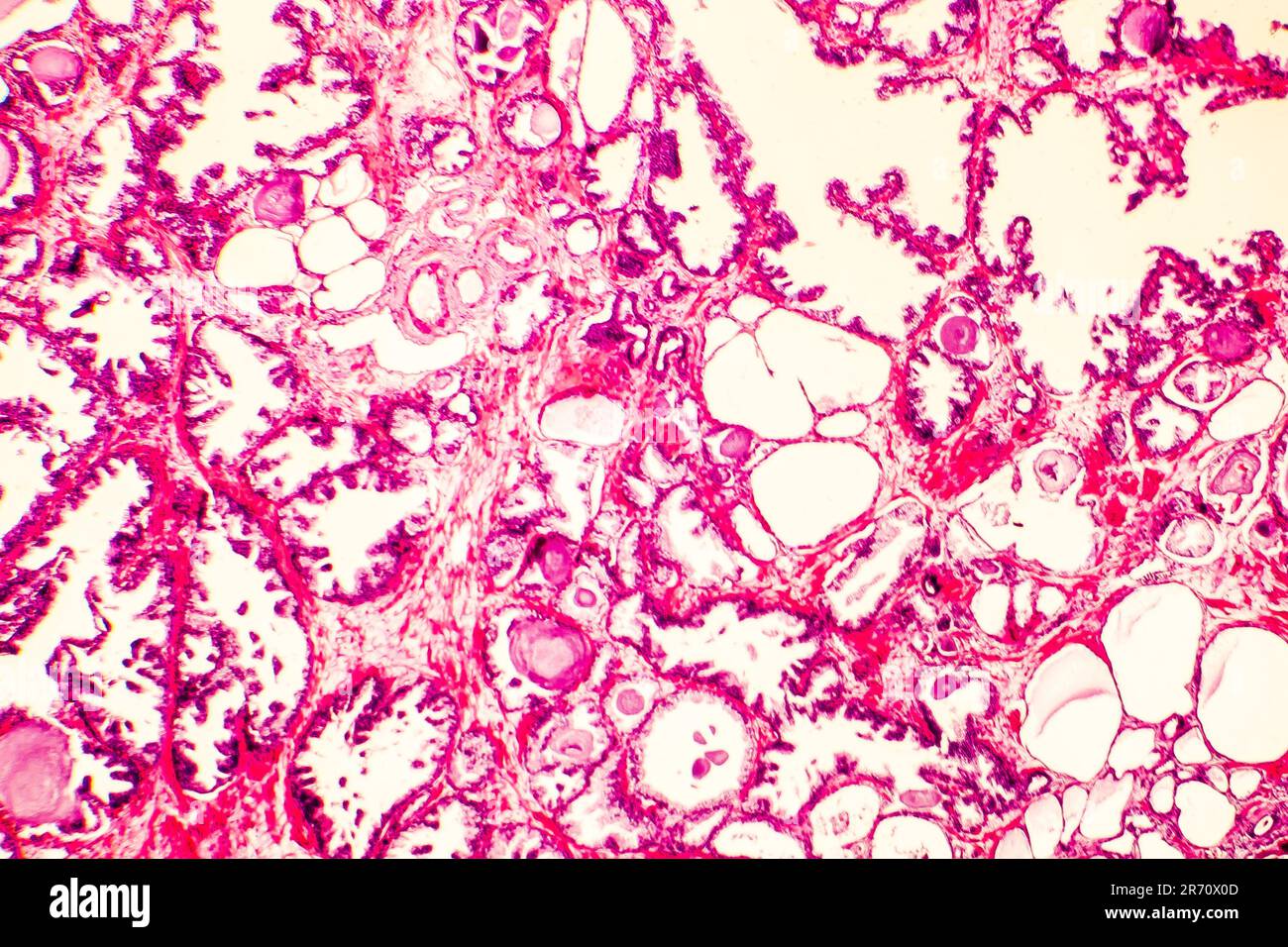 Prostate hyperplasia. Photomicrograph showing dilated glands, enfolding ...