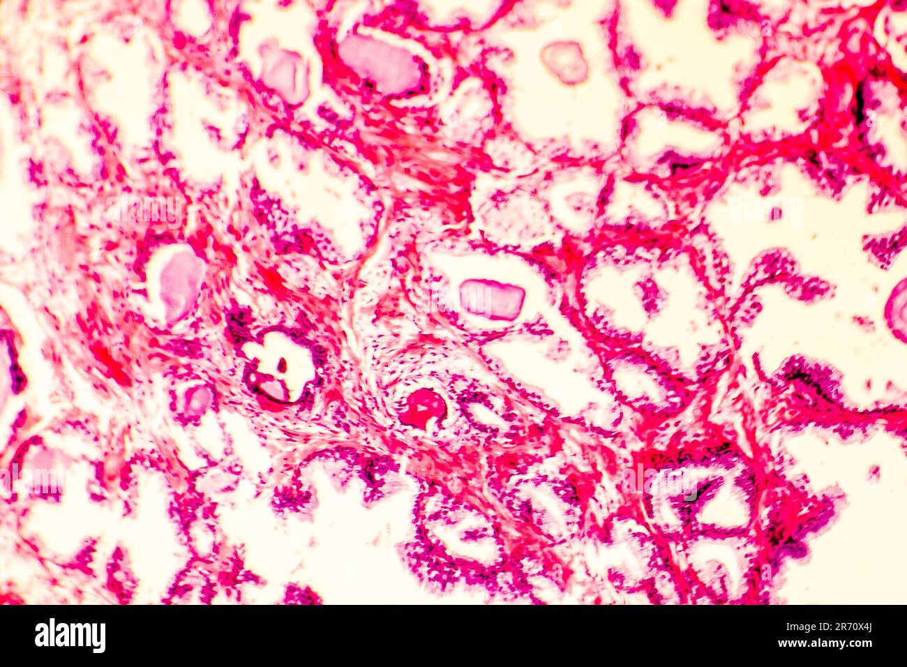 Prostate hyperplasia. Photomicrograph showing dilated glands, papillary ...