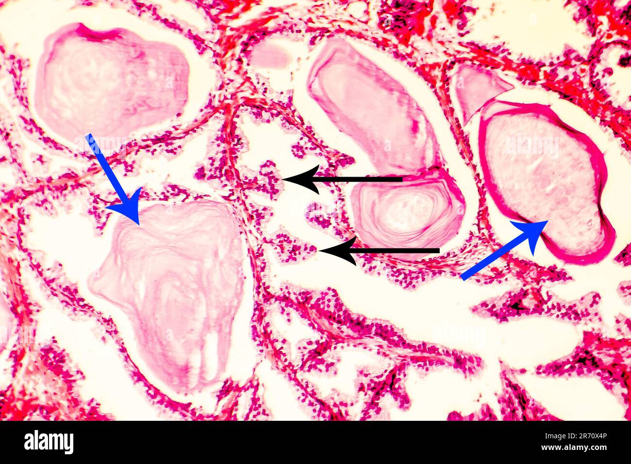 Prostate hyperplasia. Photomicrograph showing dilated glands, papillary ...