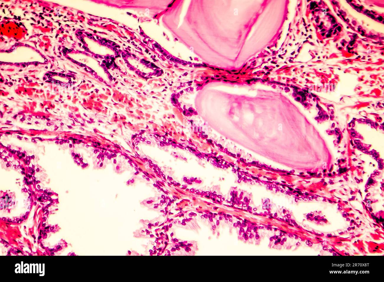 Prostate hyperplasia. Photomicrograph showing dilated glands, papillary ...