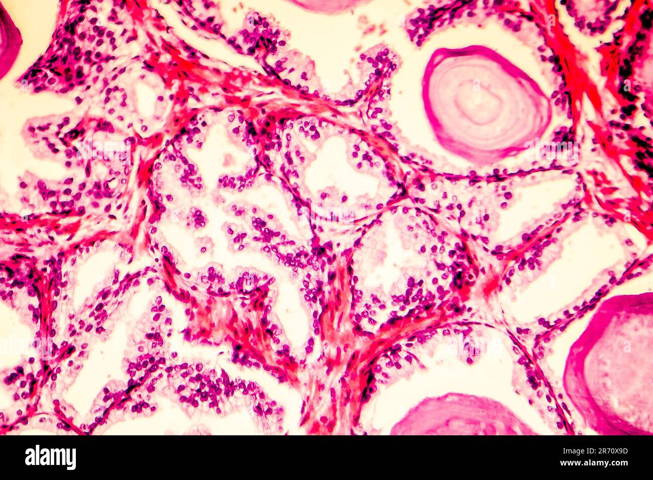 Prostate hyperplasia. Photomicrograph showing dilated glands, papillary ...