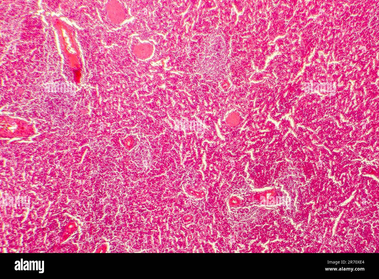 Hyaline degeneration of splenic artery, light photomicrograph Stock ...