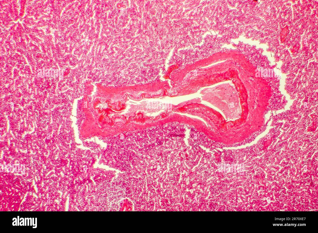 Hyaline degeneration of splenic artery, light photomicrograph Stock ...