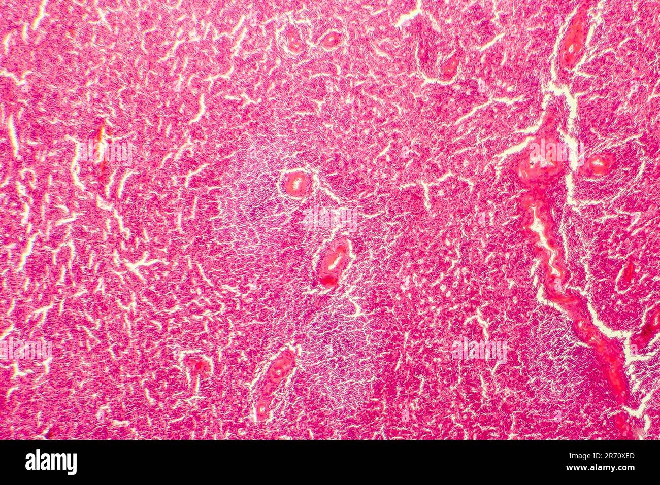 Hyaline degeneration of splenic artery, light photomicrograph Stock ...