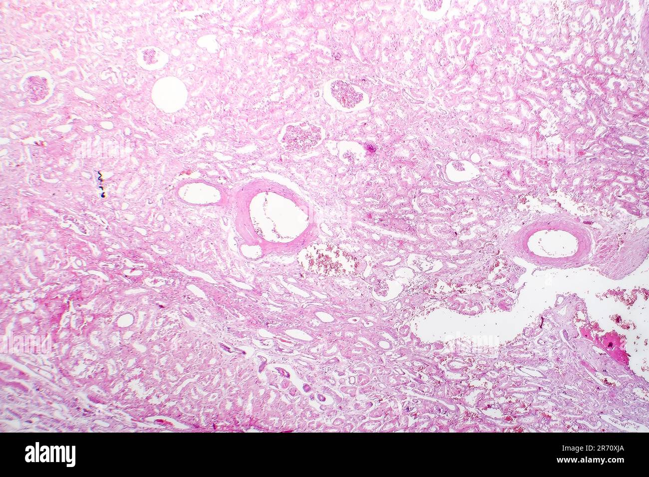 Tubular epithelial edema, light micrograph, photo under microscope ...