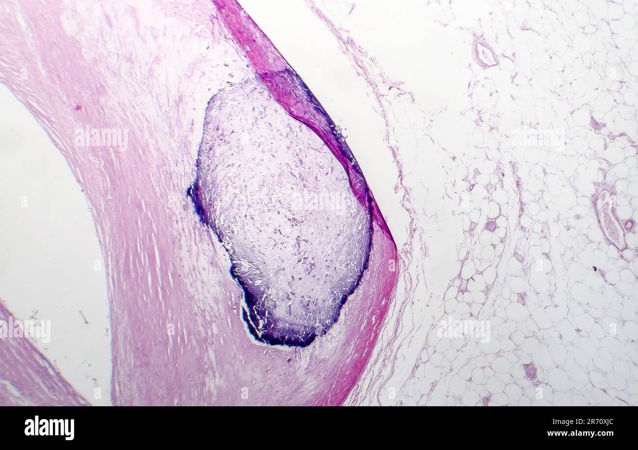 Artery calcification, narrowing of artery, light micrograph, photo ...