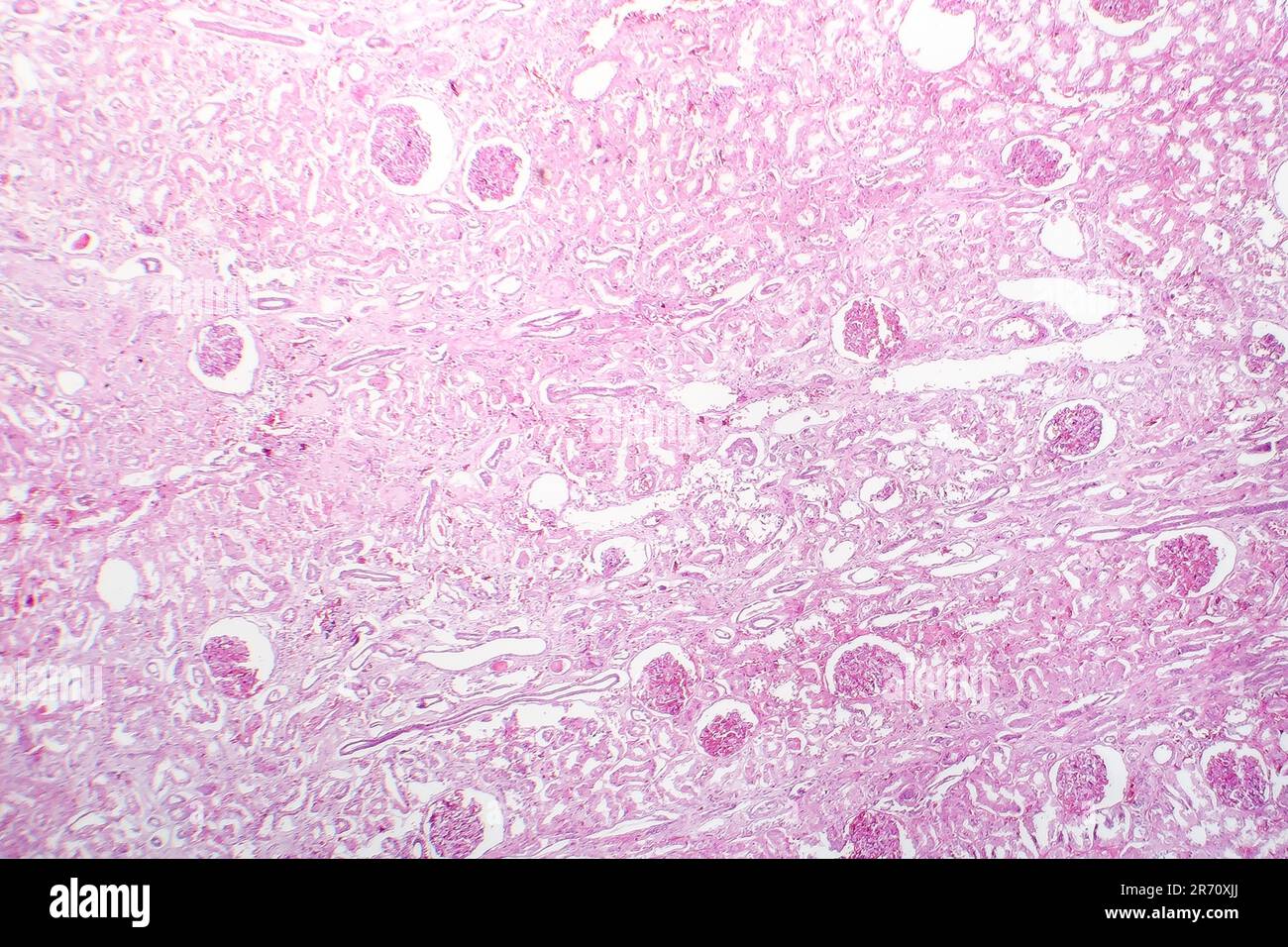 Tubular epithelial edema, light micrograph, photo under microscope ...
