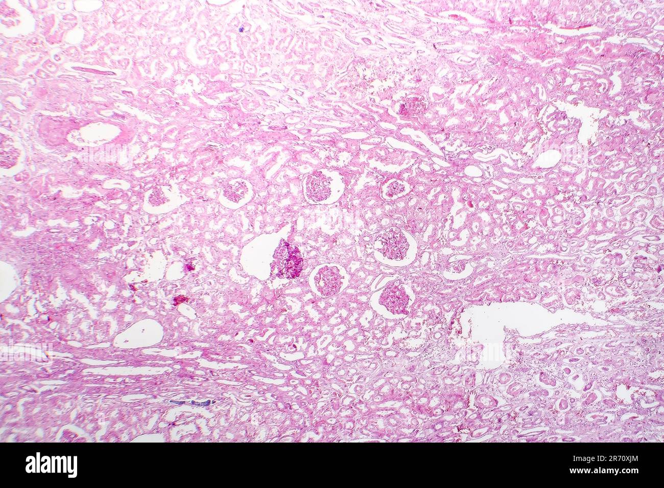 Tubular epithelial edema, light micrograph, photo under microscope ...