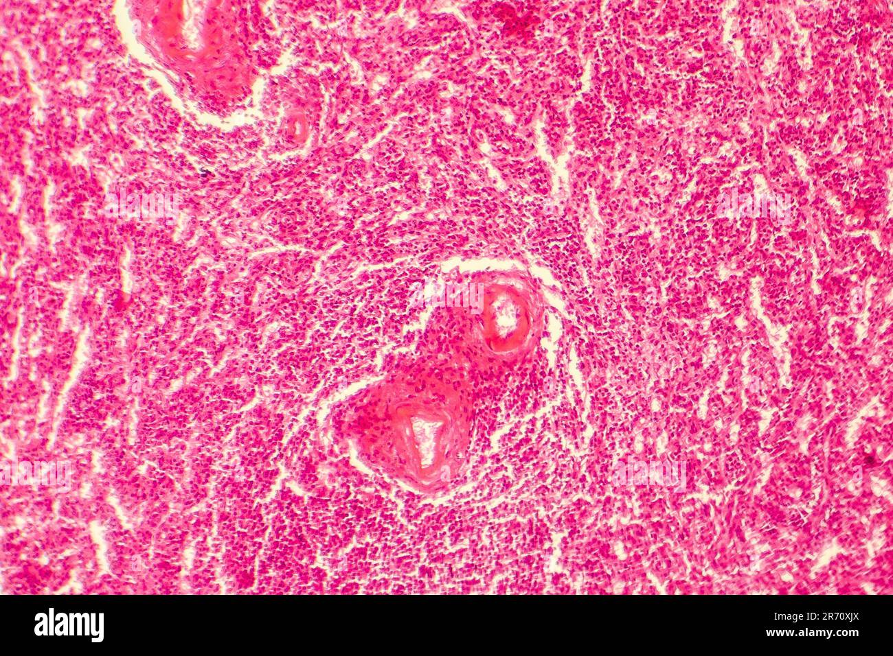 Hyaline degeneration of splenic artery, light photomicrograph Stock ...