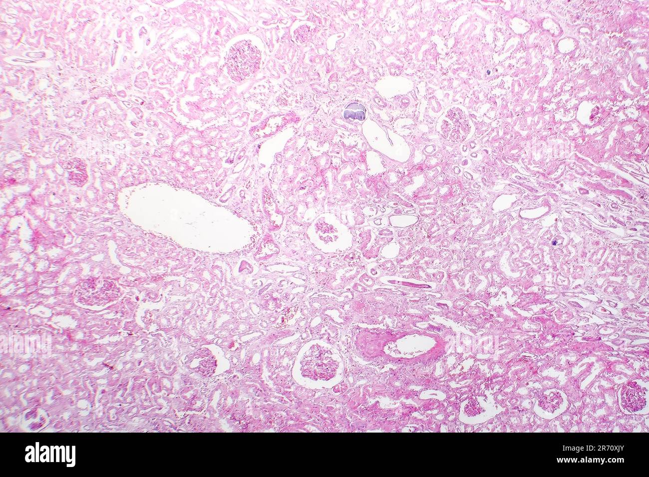 Tubular epithelial edema, light micrograph, photo under microscope ...
