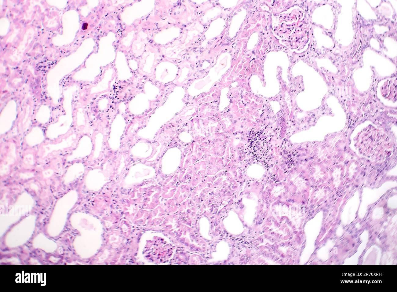 Cloudy swelling of the renal tubules in kidney, light micrograph, photo ...
