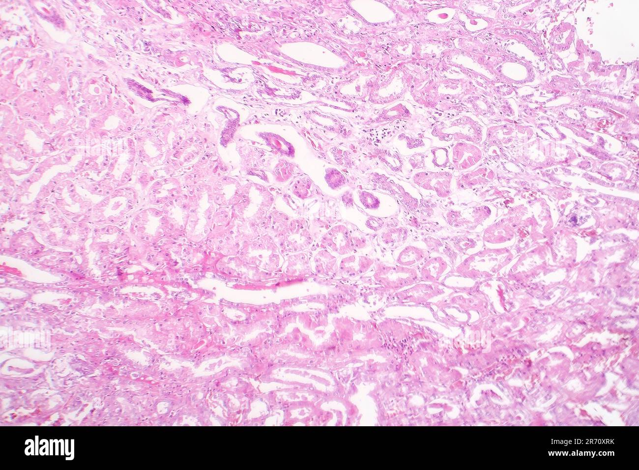 Tubular epithelial edema, light micrograph, photo under microscope ...
