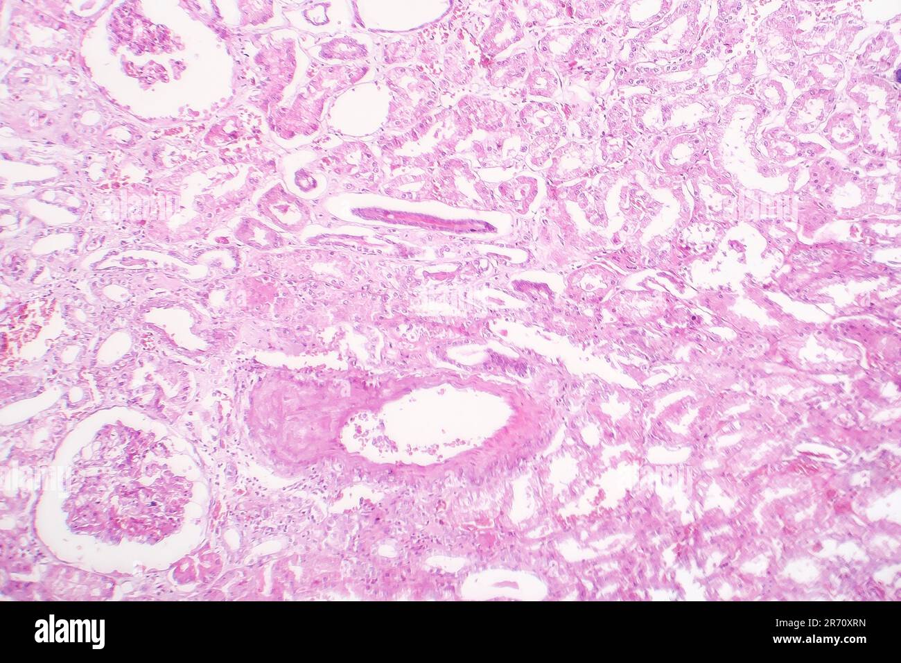 Tubular epithelial edema, light micrograph, photo under microscope ...