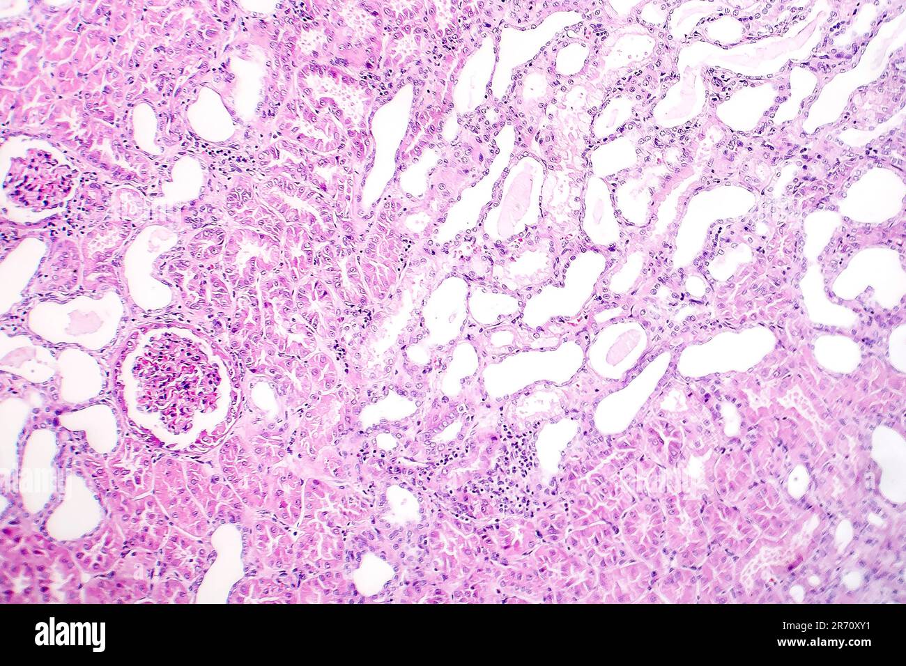 Cloudy swelling of the renal tubules in kidney, light micrograph, photo ...