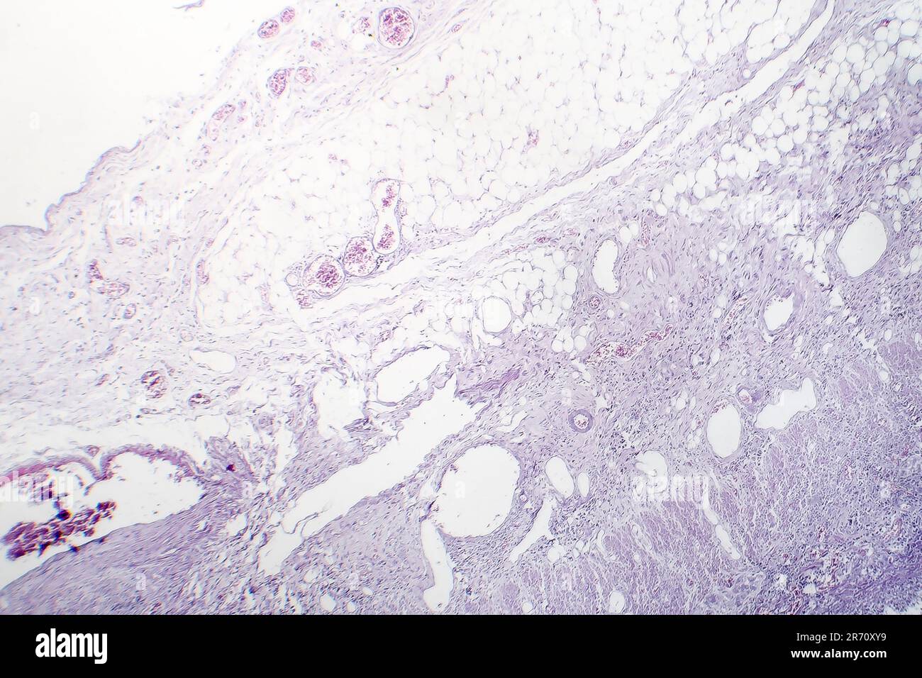 Granulomatous inflammation, light micrograph, photo under microscope ...