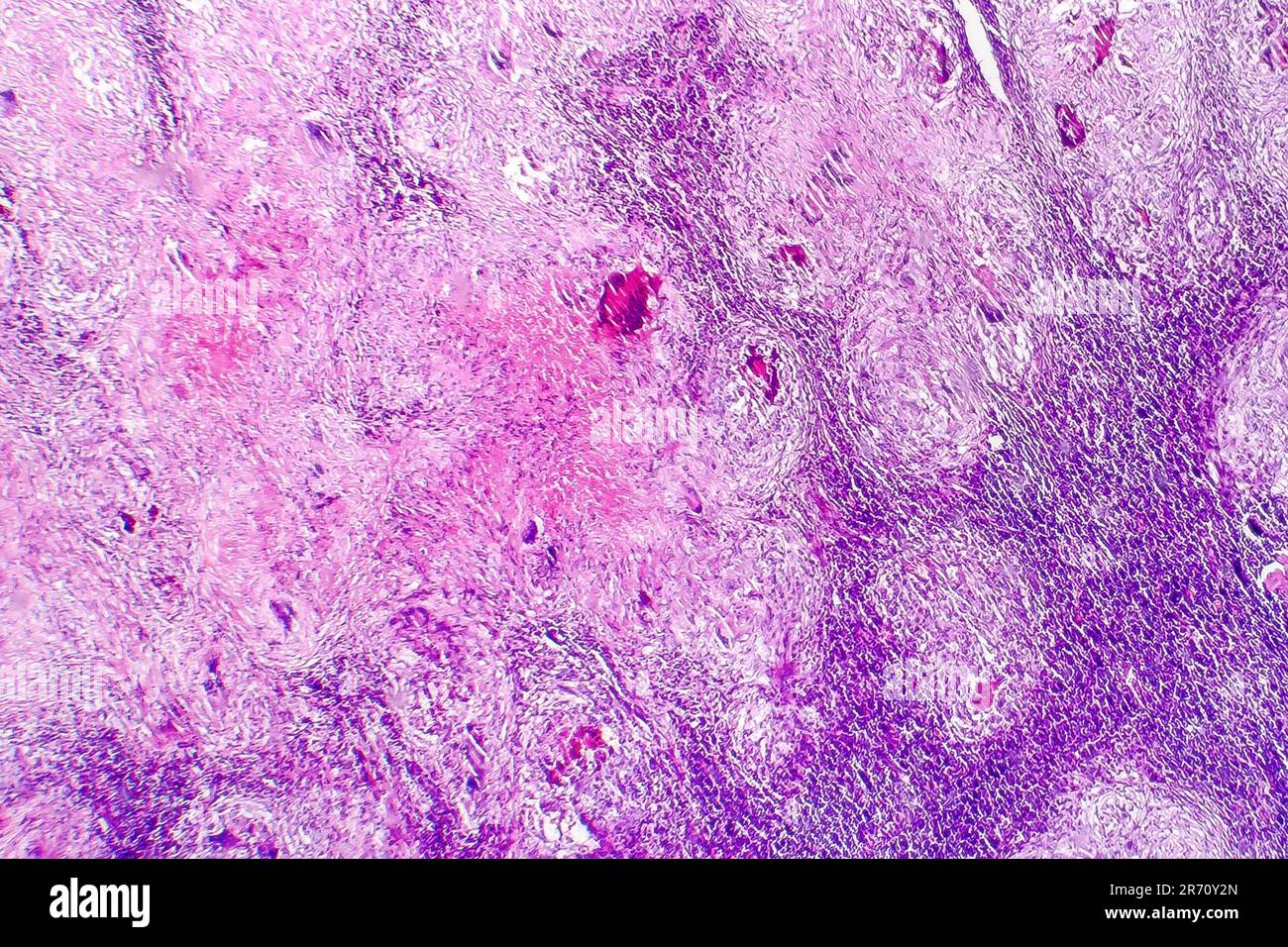 Caseous necrosis of lymphatic node, light micrograph, photo under ...