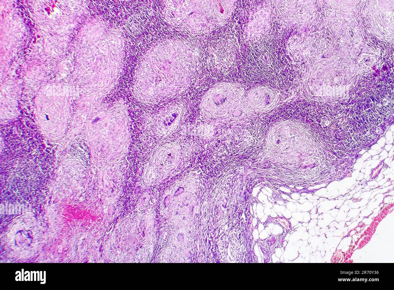 Caseous Necrosis In Tb