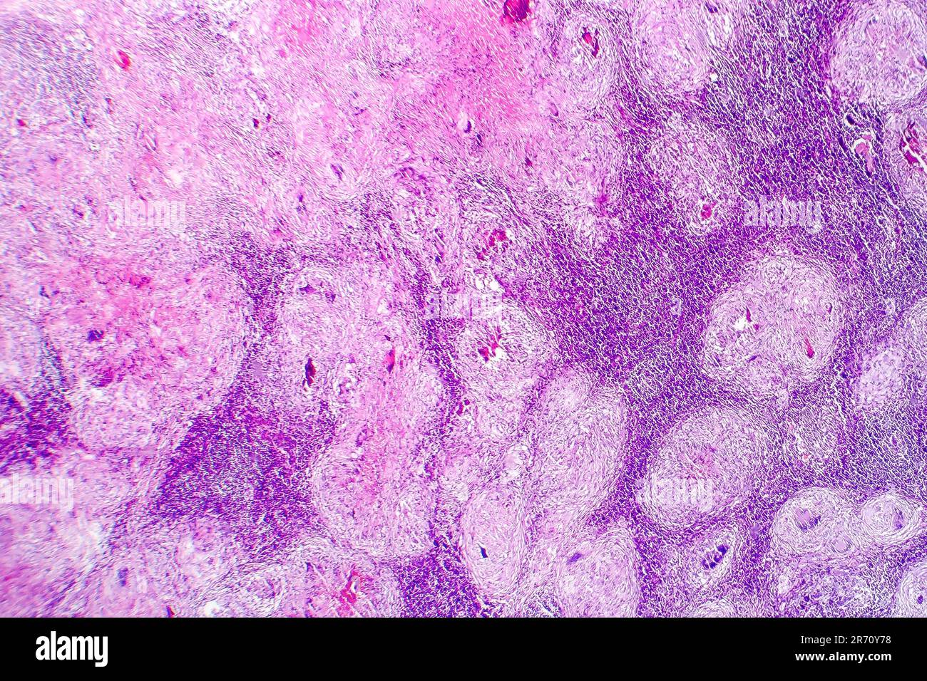 Caseous necrosis of lymphatic node, light micrograph, photo under ...