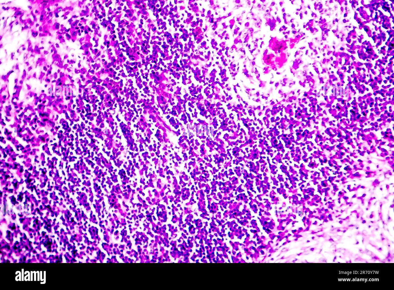 Caseous necrosis of lymphatic node, light micrograph, photo under ...